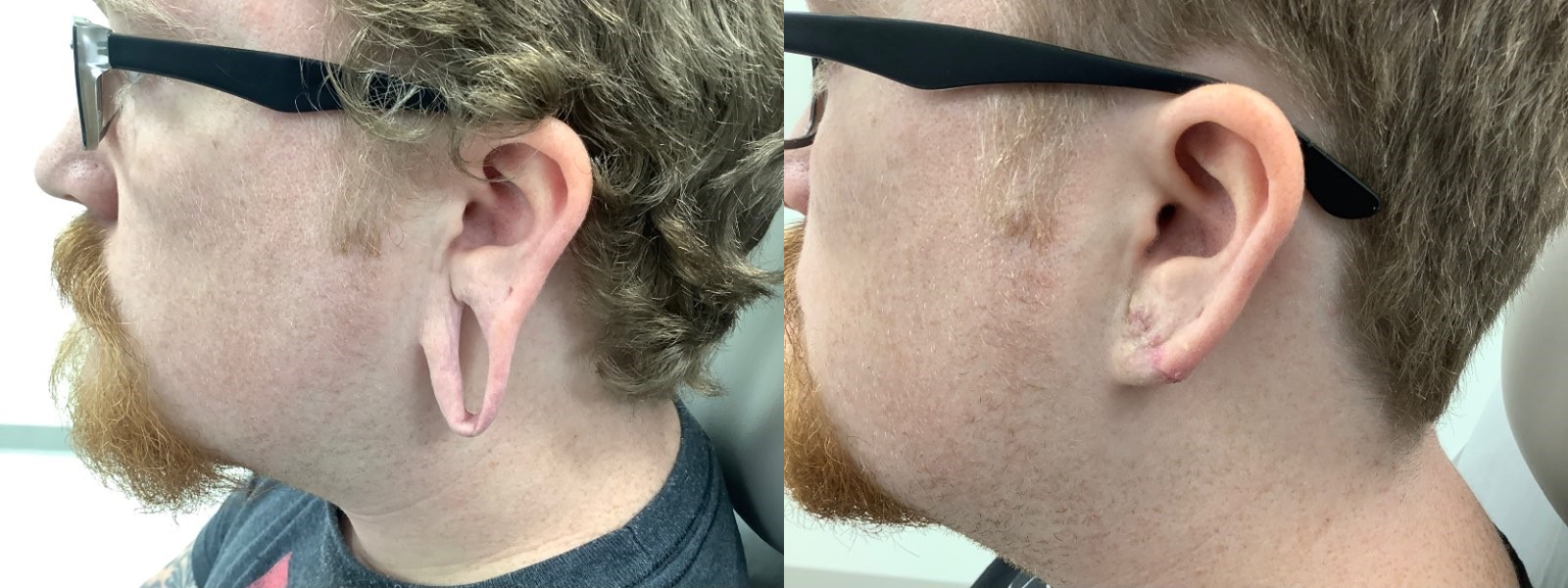 Ear Lobe Repair – Carolinas Dermatology Group