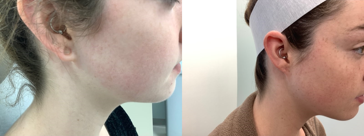 Ear Lobe Repair – Carolinas Dermatology Group