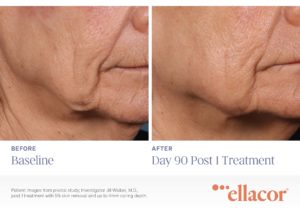 Ellacor – Carolinas Dermatology Group